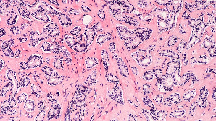 Do biopsies spread prostate cancer?