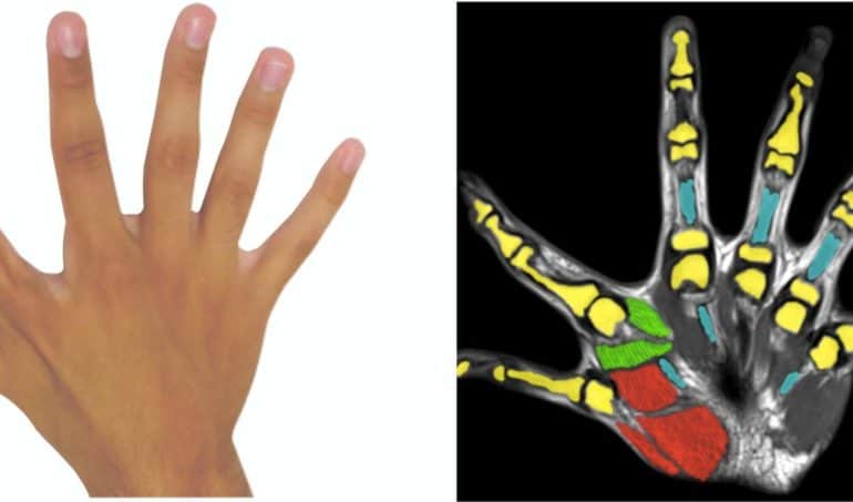 Extra Finger ‘Birth Defect’ Could Provide Blueprint for Robotic Extra Limbs