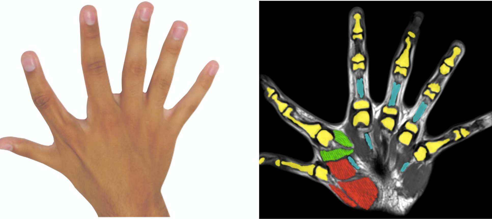 Extra Finger ‘Birth Defect’ Could Provide Blueprint for Robotic Extra Limbs