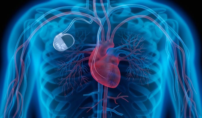 Managing life with a pacemaker