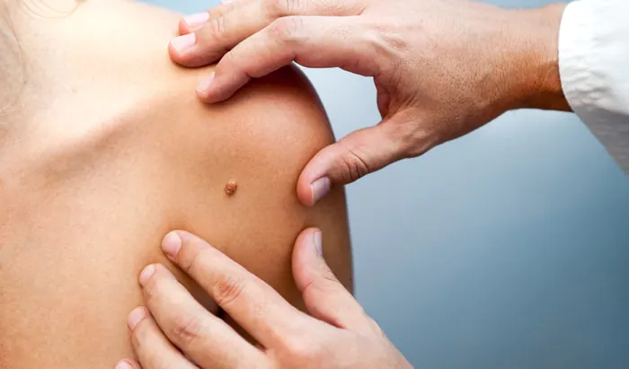 New skin microbiopsy device developed